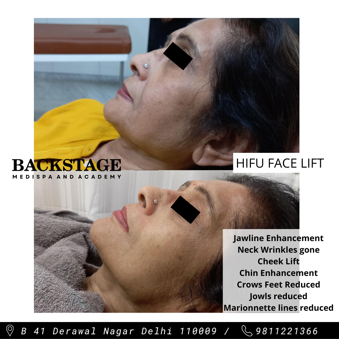 HIFU Treatment Non Surgical Facelift Dr Geeta Arora Backstage Delhi HIFU Treatment Non Surgical Facelift Dr Geeta Arora Backstage Delhi